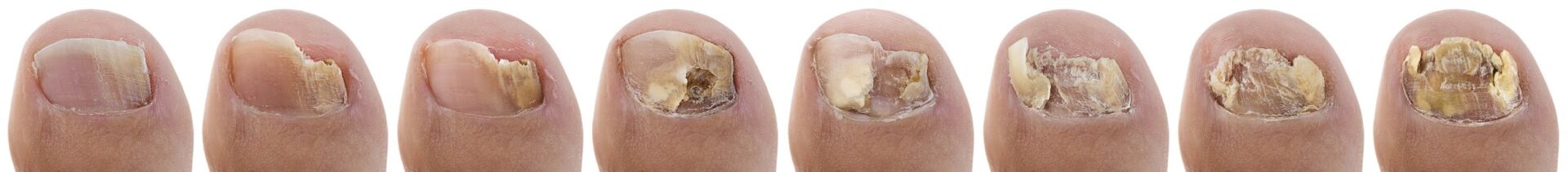 4 Signs You Have A Fungal Nail Infection - And How To Stop It ...