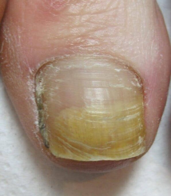 4 Signs You Have A Fungal Nail Infection - And How To Stop It ...